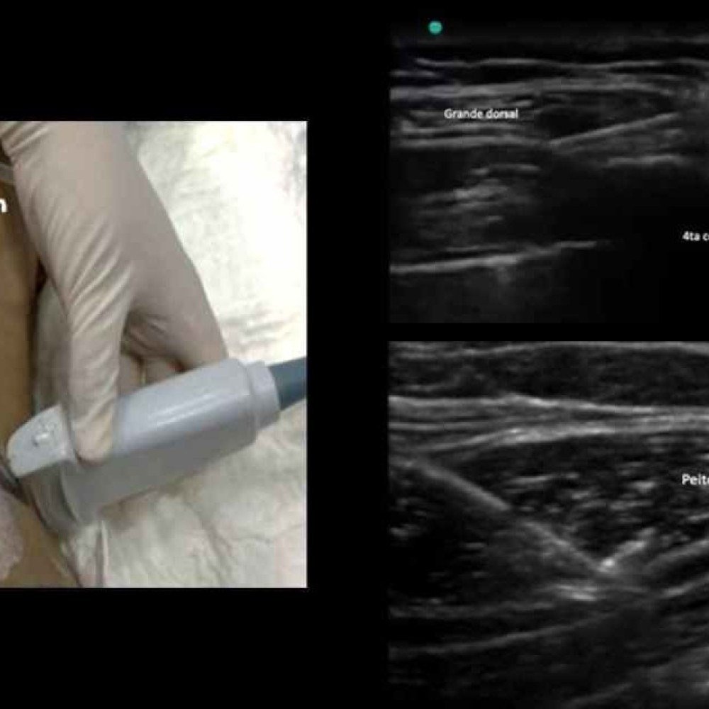 Técnica reduz a incidência de dor crônica e depressão pós-mastectomia