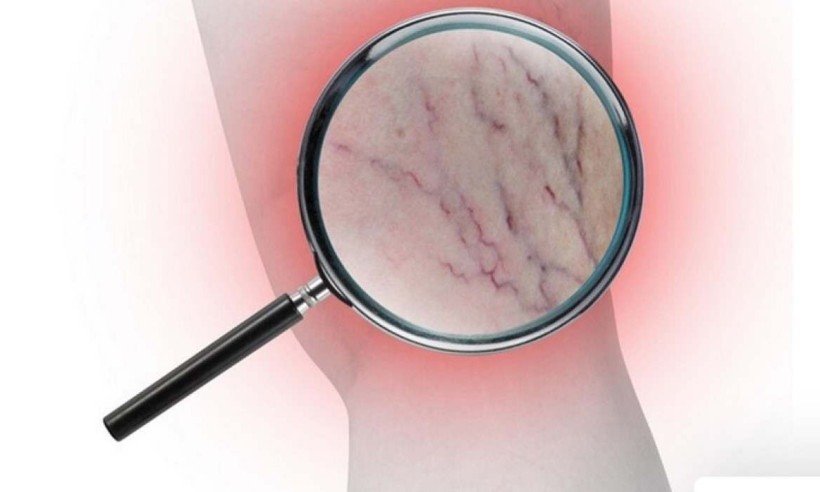 Varizes: mitos e verdades - Jornal Estado de Minas | Notícias Online