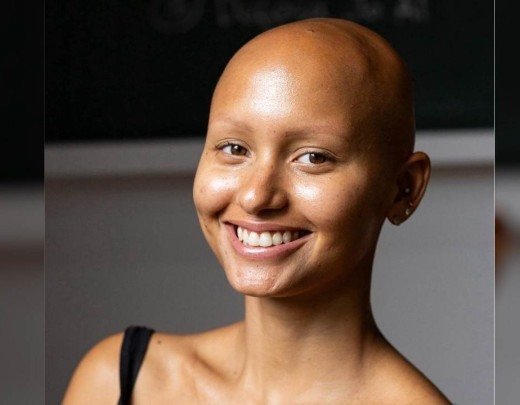 Modelo que nasceu careca desmistifica a alopecia