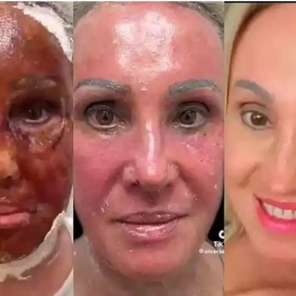 Peeling de fenol: saiba o que é e quais cuidados devem ser tomados