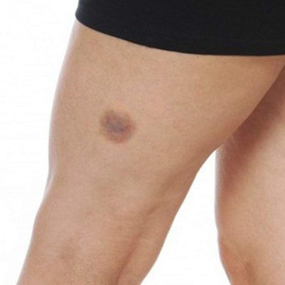 Mancha roxa pode ser problema vascular. Saiba a hora de procurar um médico