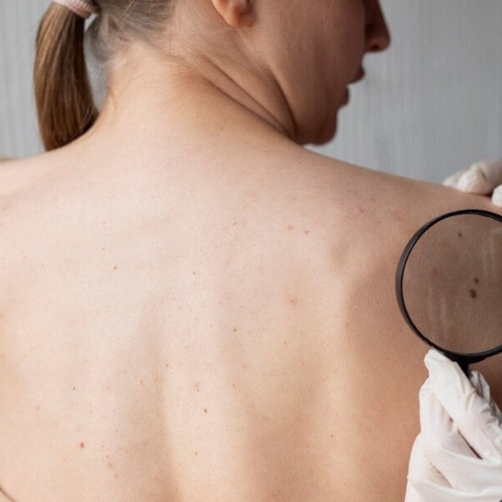 O que são pintas suspeitas na pele e porque elas precisam ser removidas