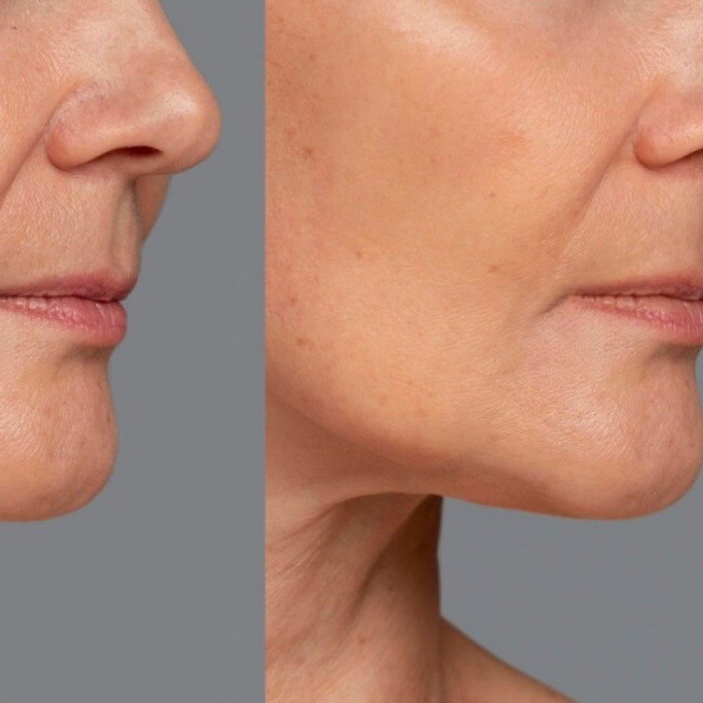 Papada não é só gordura: causas, tratamentos e o impacto na autoestima